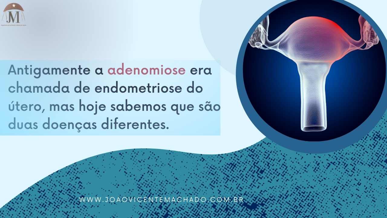 Você sabe o que é a adenomiose? | Site do João Vicente Machado