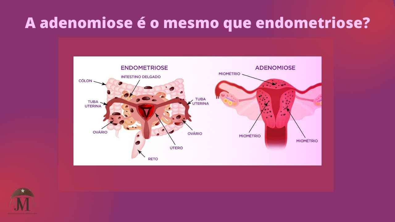 Você sabe o que é a adenomiose? | Site do João Vicente Machado